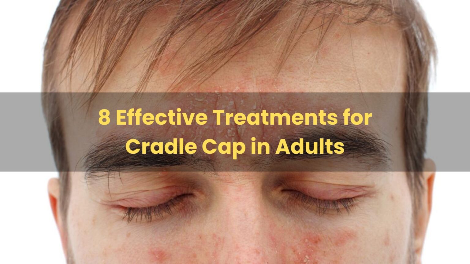8 Effective Treatments for Cradle Cap in Adults - Life and Experiences